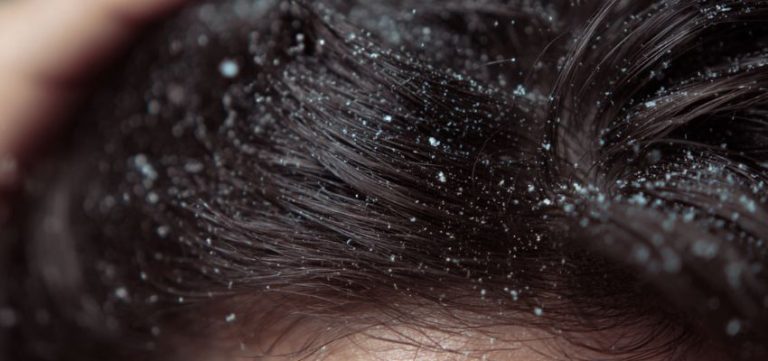 Dry Scalp or Dandruff? Experts Reveal the Key Signs to Know